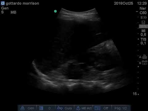 Vista postero lateral derecha, espacio de Morrison. - YouTube