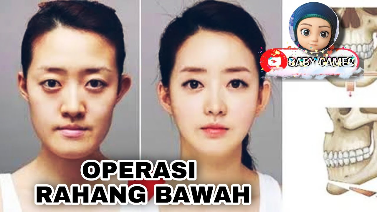 OPERASI RAHANG BAWAH - YouTube