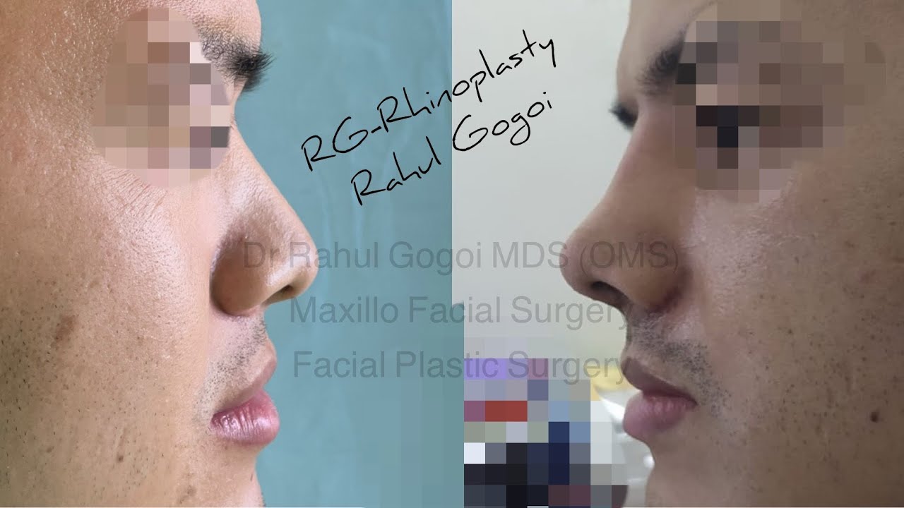 Asian Rhinoplasty - Nose Job India before and after surgery ...
