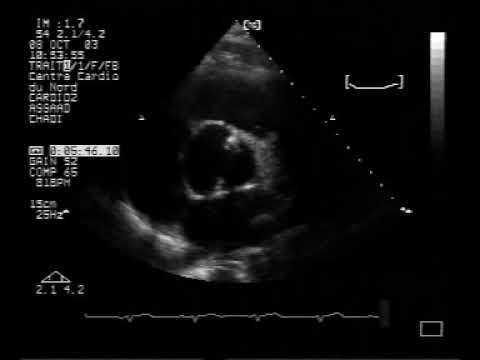 echocardiogram:calcified bicuspid aortic valve - YouTube