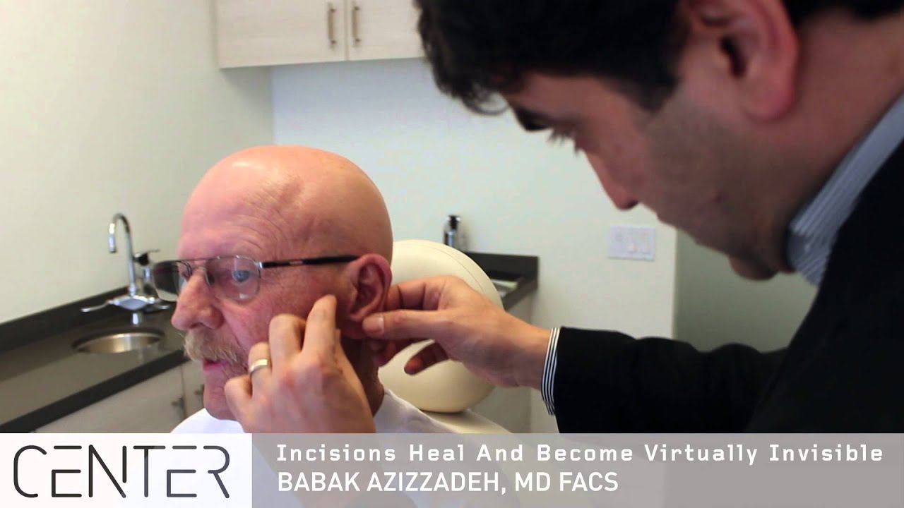 Micro Parotidectomy Surgery One Year Later | Dr. Larian & Dr. Azizzadeh ...