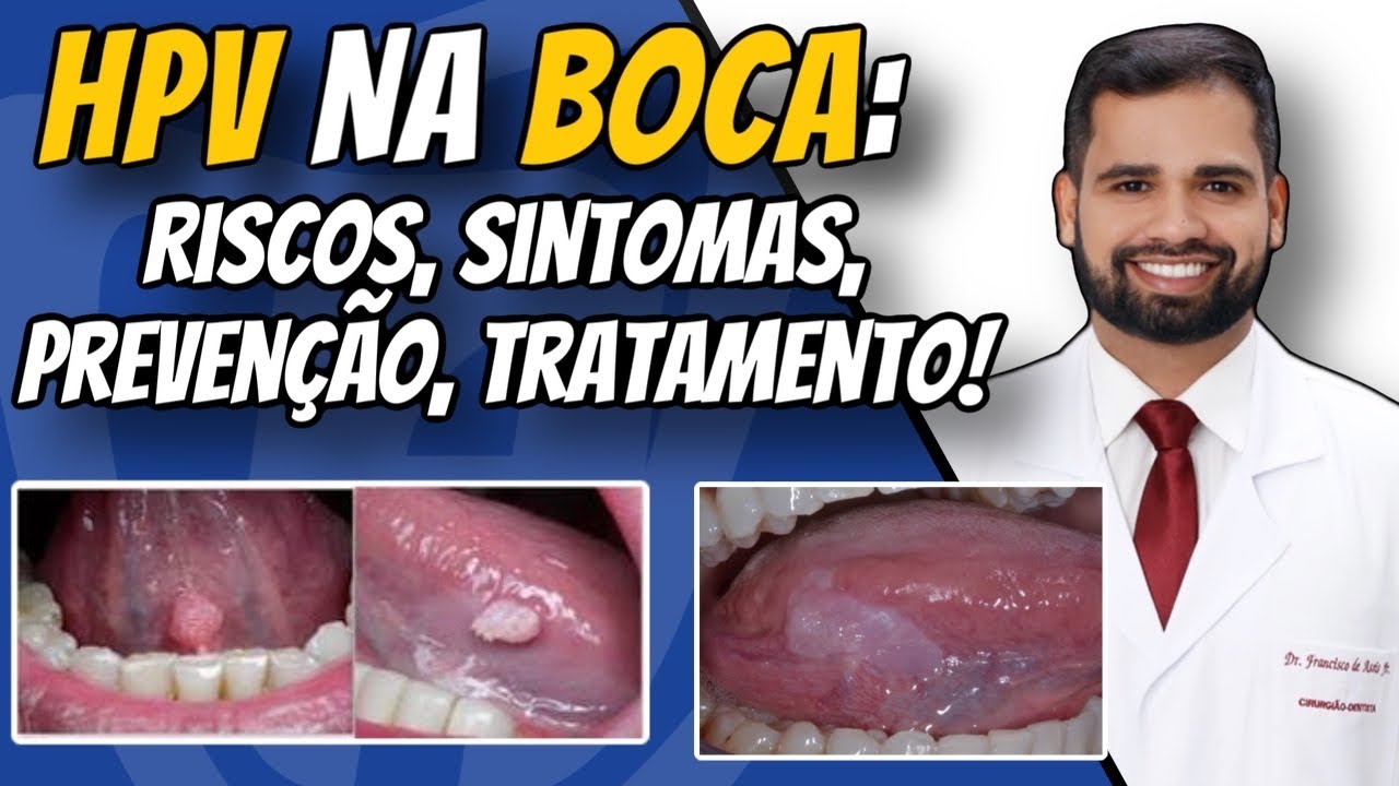Hpv Na Boca Quais Os Sintomas - NAZAEDU