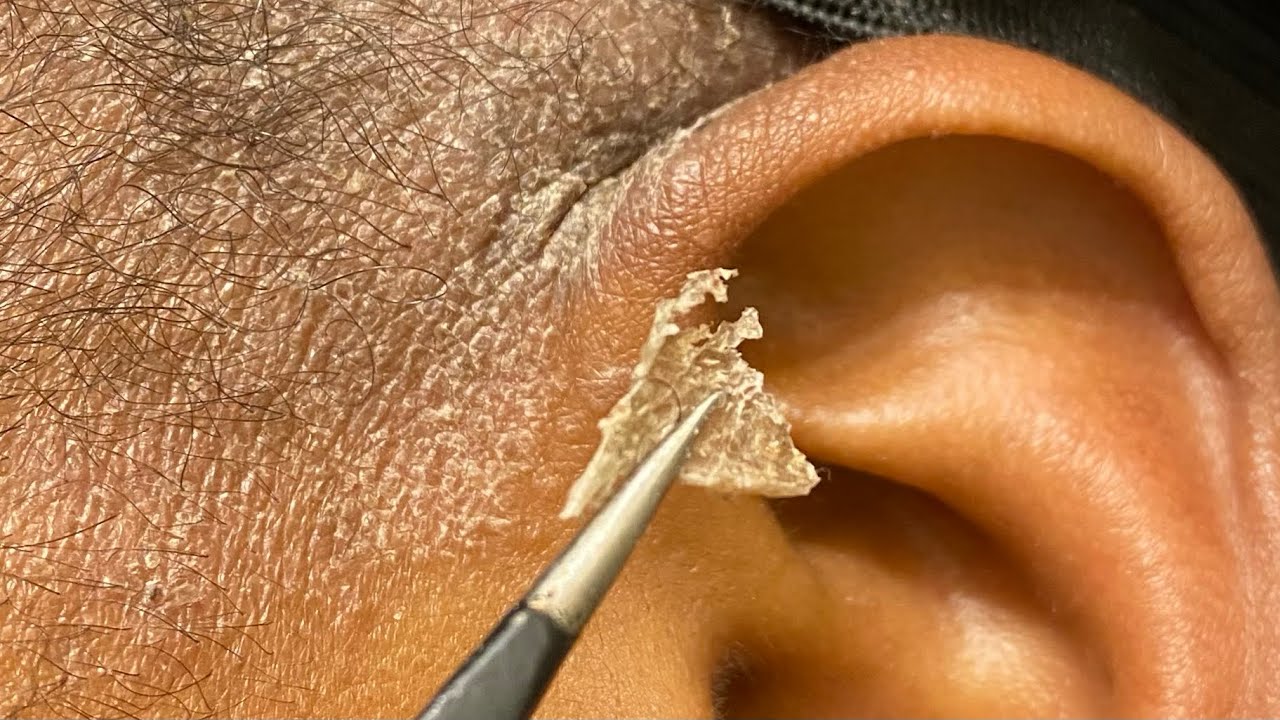 TOUGH FLAKES |Behind Ear Peel|Scalp Check|Ear Update(Healing Beautiful ...