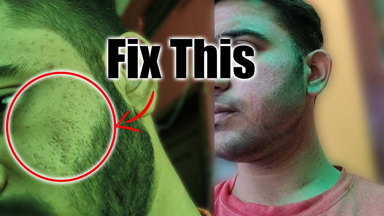 How To Remove Scars From Face Remove Scar From Face In 7 Days 100 YouTube how-to-remove-scars-from-face-remove-scar-from-face-in-7-days-100-youtube