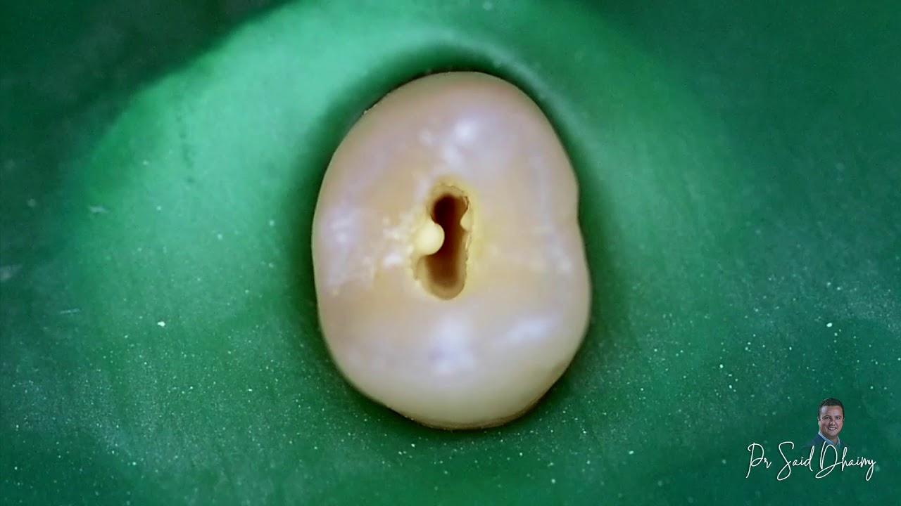 Endodontic access cavity - maxillary first premolar - Pr Said DHAIMY ...