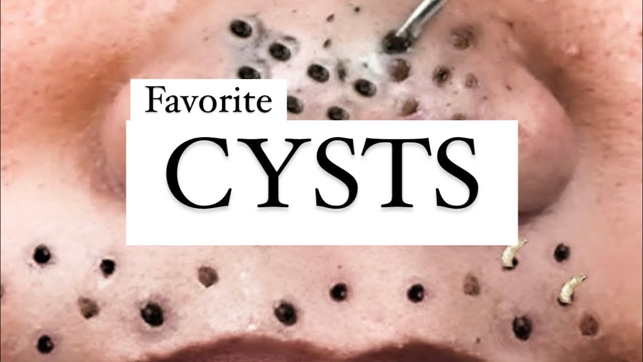 All My Favorite Pops! Watson Explores Popping Warning: Pimples - YouTube