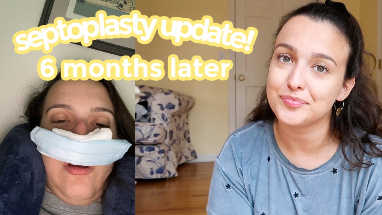 Deviated Septum Surgery Recovery Pictures