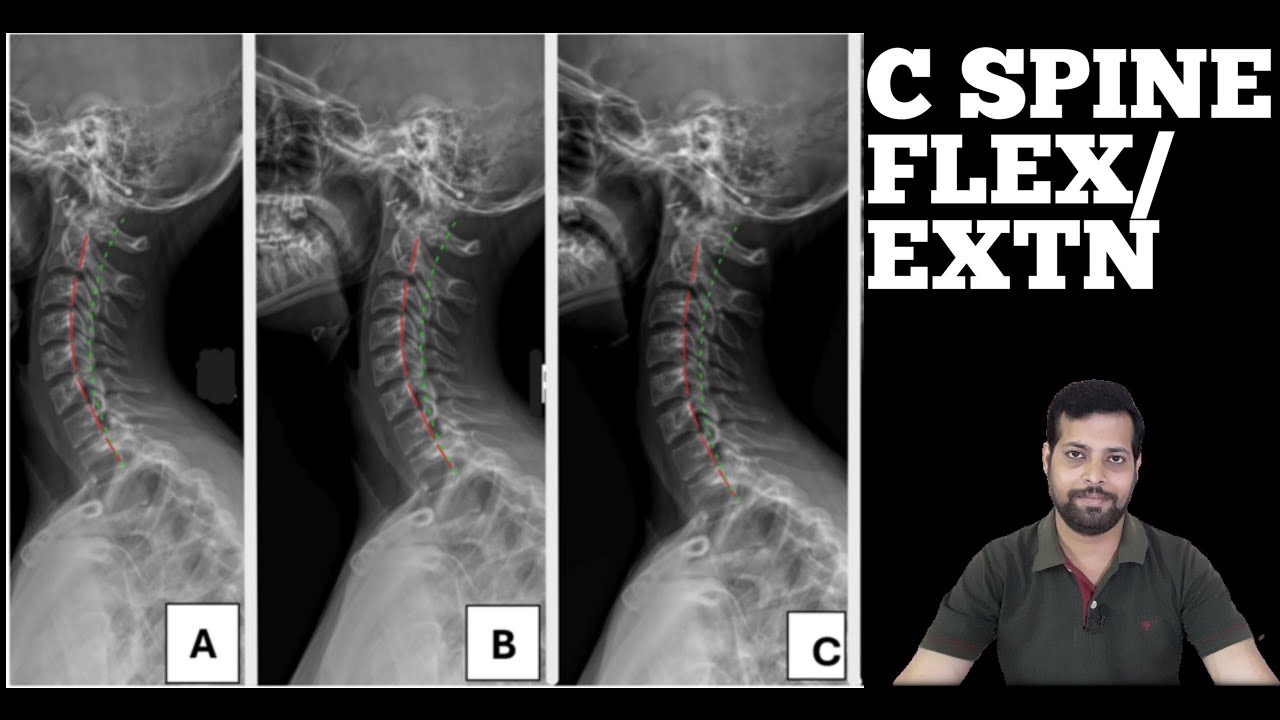 CERVICAL SPINE NEUTRAL, FLEXION AND EXTENSION VIEW, OBLIQUE VIEWS # ...