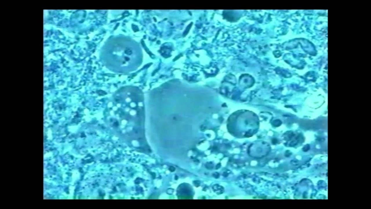 periodontitis Aggressive localised, 35 years old, Parasite Alert. A ...