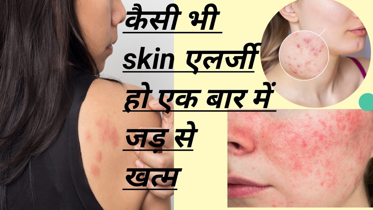 how to treat skin fungal infection | skin allergi daad khaj kujli ko ...