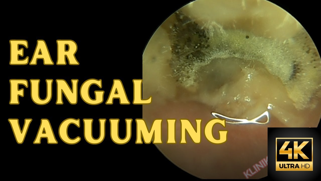Fungal In Ear Suctioning (4K 60FPS) - YouTube