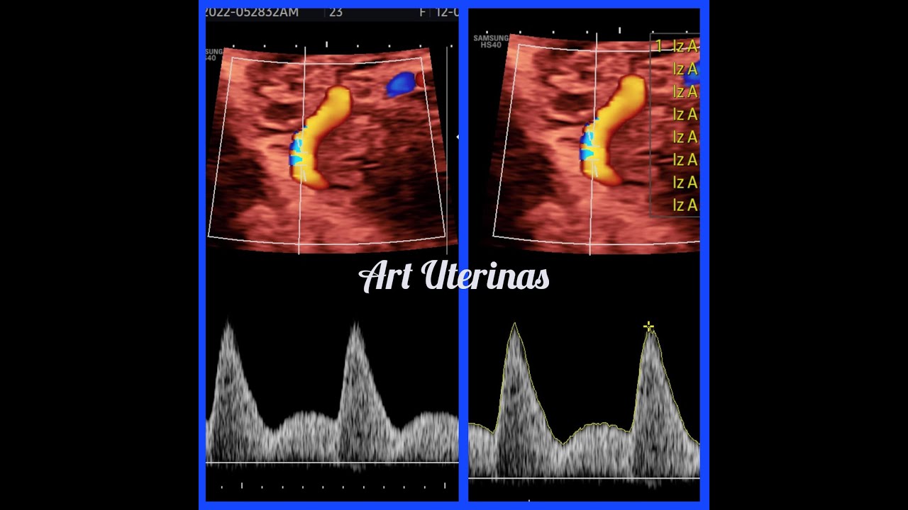 Cómo obtener las Arterias Uterinas en el 1er trimestre? - YouTube