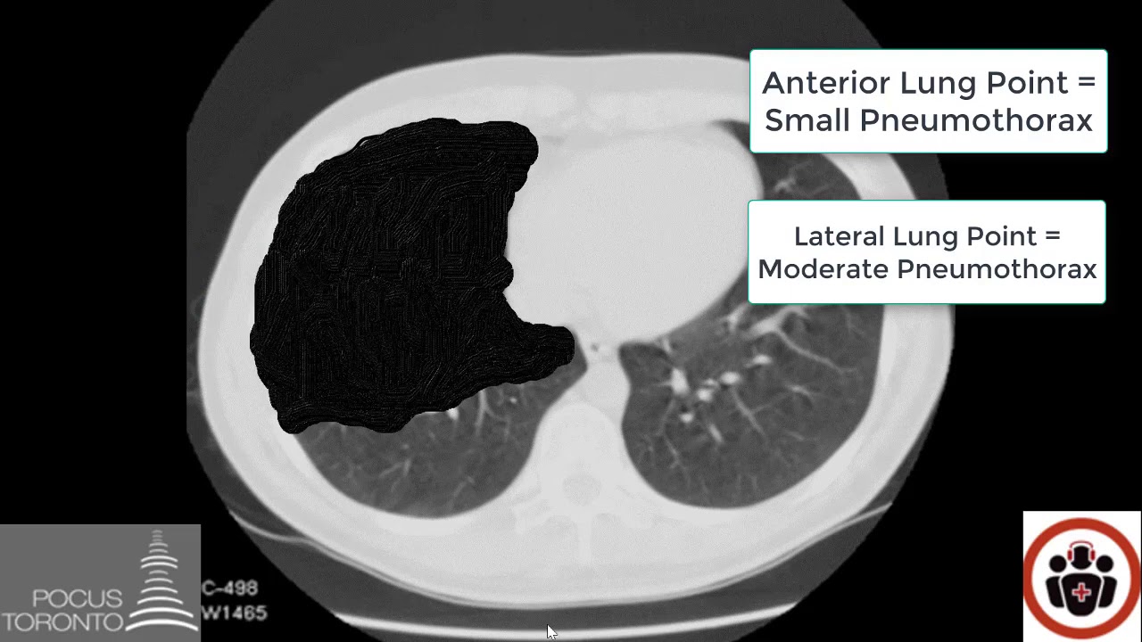 POCUS Cases 1: Pneumothorax - YouTube