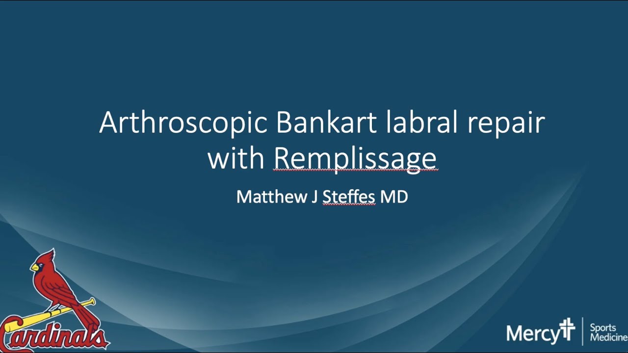 Arthroscopic shoulder anterior labrum repair and remplissage - YouTube