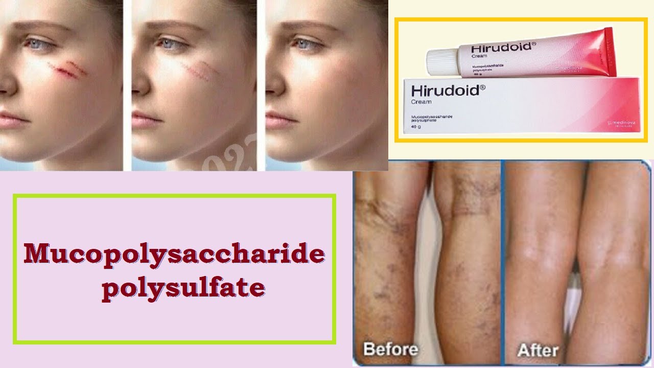mucopolysaccharide polysulfate - YouTube