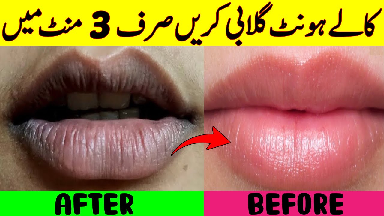 Get Rid of DARK DRY CHAPPED & PIGMENTED LIPS in Just 5 Days | Get PINK ...