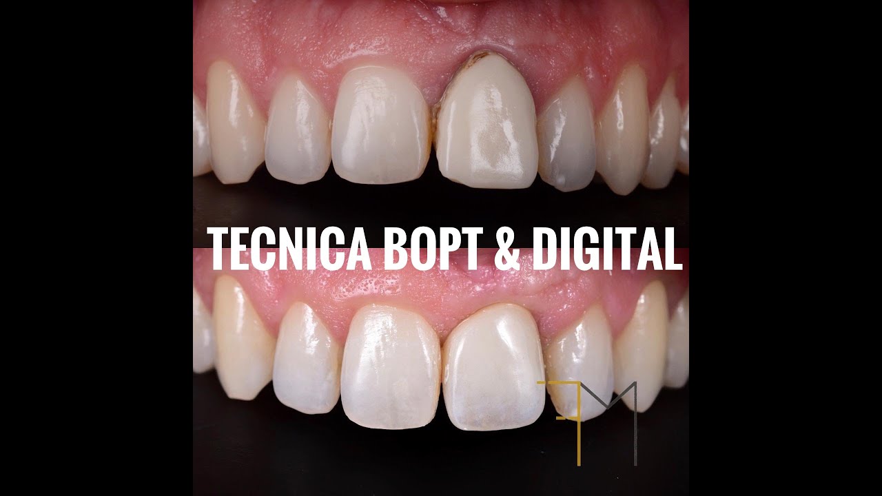 Corona Zirconio con Tecnica BOPT para diente discromico