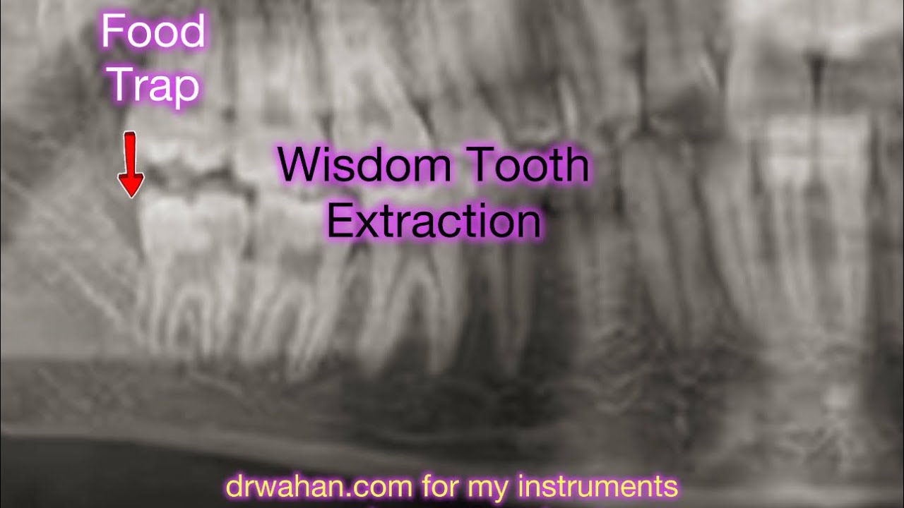 Tissue Impaction Wisdom Tooth Removal - YouTube