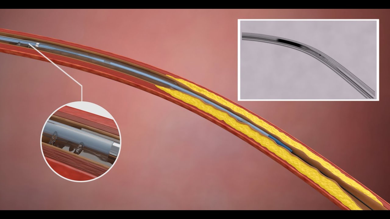 Finesse BTK catheter for peripheral arterial surgeries - 3D animation ...