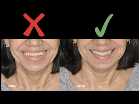 O QUE É SORRISO INVERTIDO? PROBLEMA ESTÉTICO! - YouTube