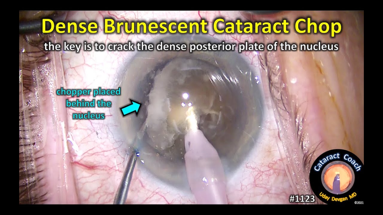CataractCoach 1123: dense brunescent cataract surgery phaco chop - YouTube