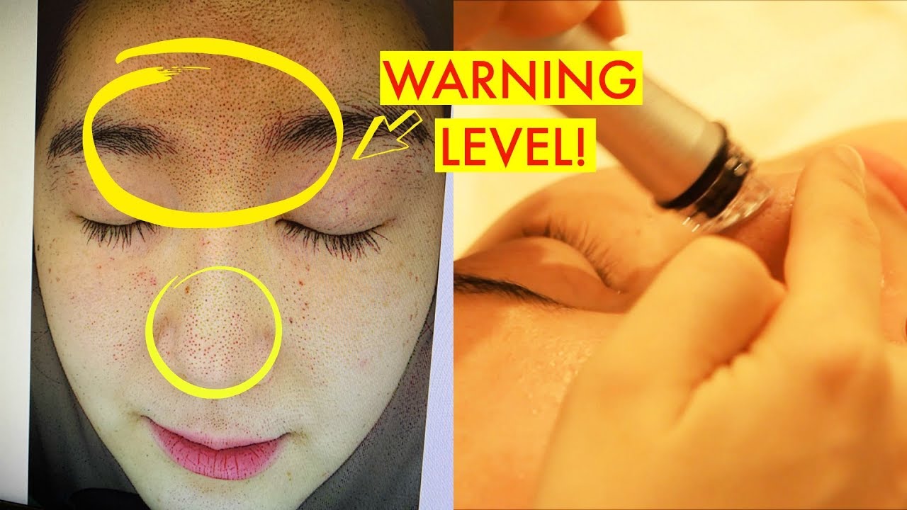 Dermatologist Tip to Suck Out ALL Gunk & Shrink Pores - YouTube