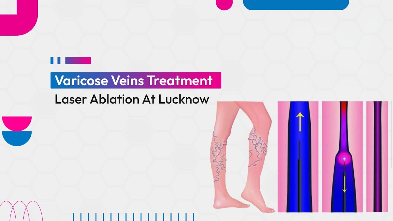 VARICOSE VEINS LASER procedure: 𝐀𝐝𝐯𝐚𝐧𝐜𝐞𝐝 𝐓𝐫𝐞𝐚𝐭𝐦𝐞𝐧𝐭 𝐢𝐧 𝐋𝐮𝐜𝐤𝐧𝐨𝐰 𝐛𝐲 𝐃𝐫 ...