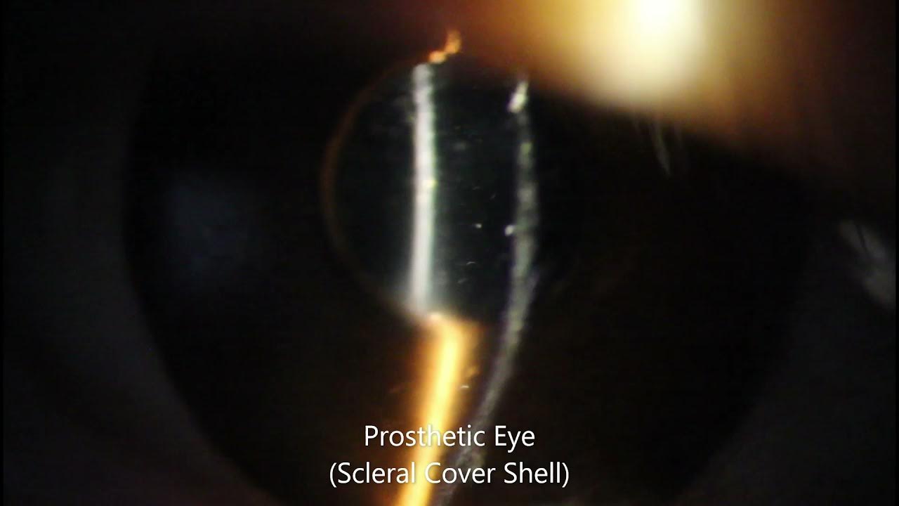 Prosthetic Eye Scleral Cover Shell And Live Eye Spk And Pco Youtube