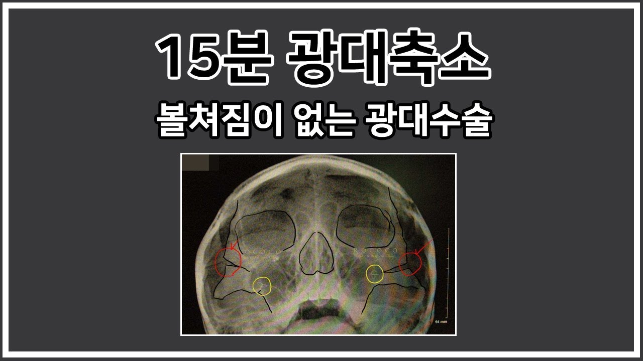 x-ray로 알아보는 15분광대축소술 - 퀵광대(reduction malarplasty/cheekbone reduction ...