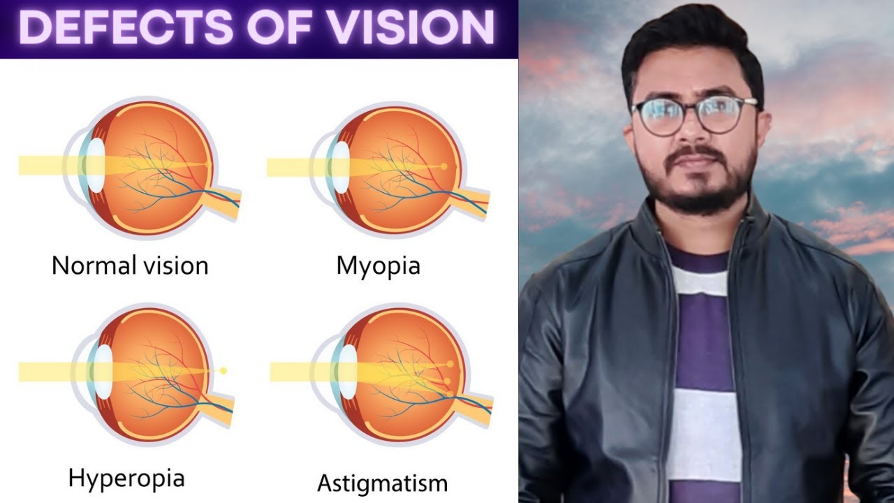 Defects of Vision I NTSE PHYSICS I Sameer Sir I Gravity Classes #ntse ...