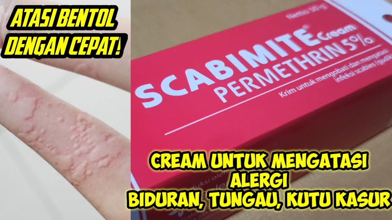 SCABIMITE CREAM Obat Alergi Bentol-bentol - YouTube