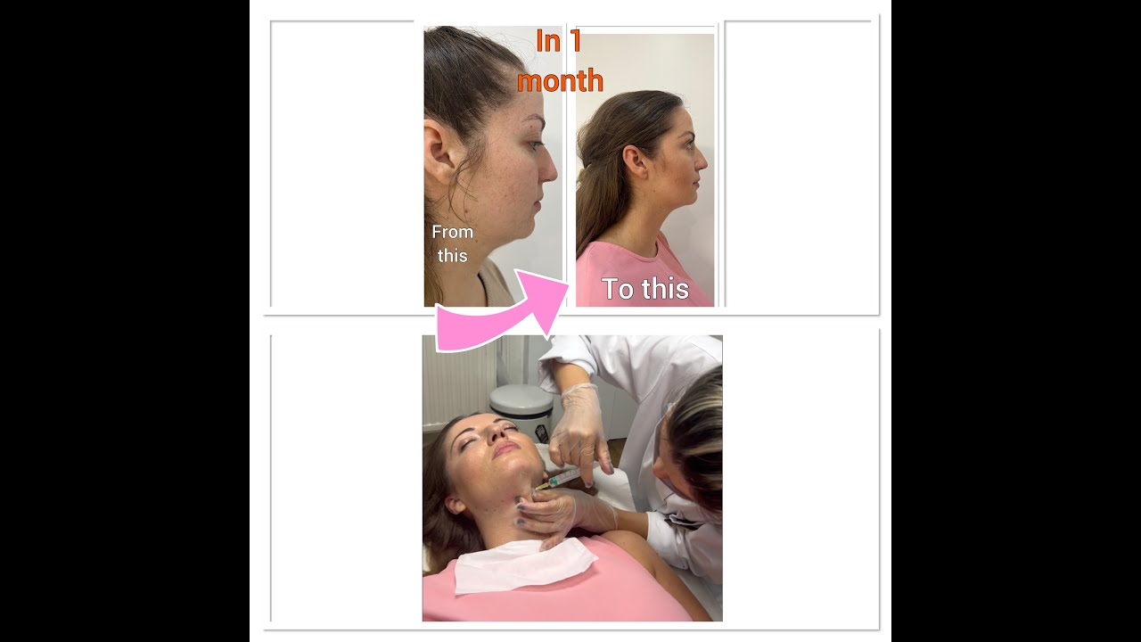 Permanently Remove the Double Chin-fat dissolving before and after ...