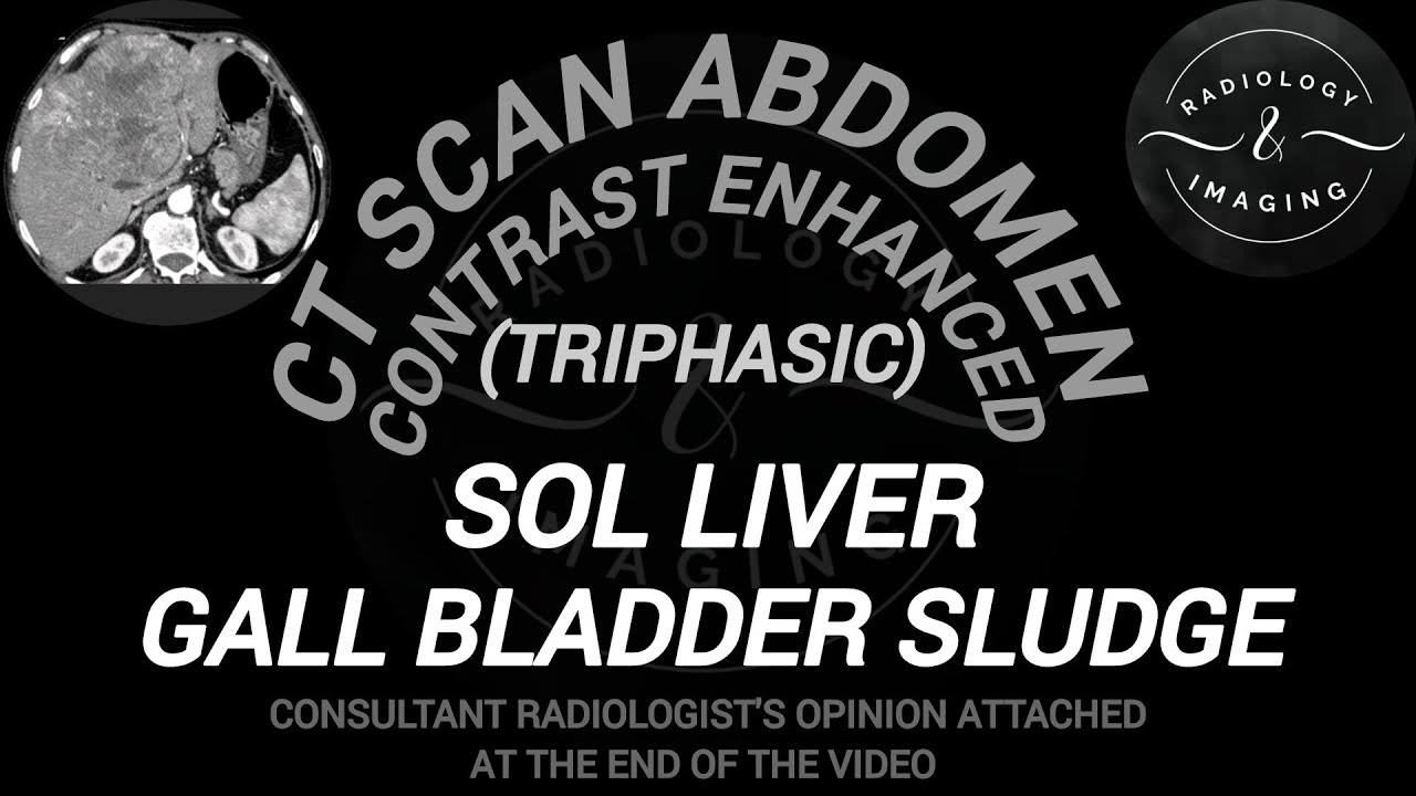 CT Scan Abdomen Contrast Enhanced(Triphasic) to rule out SOL Liver and ...