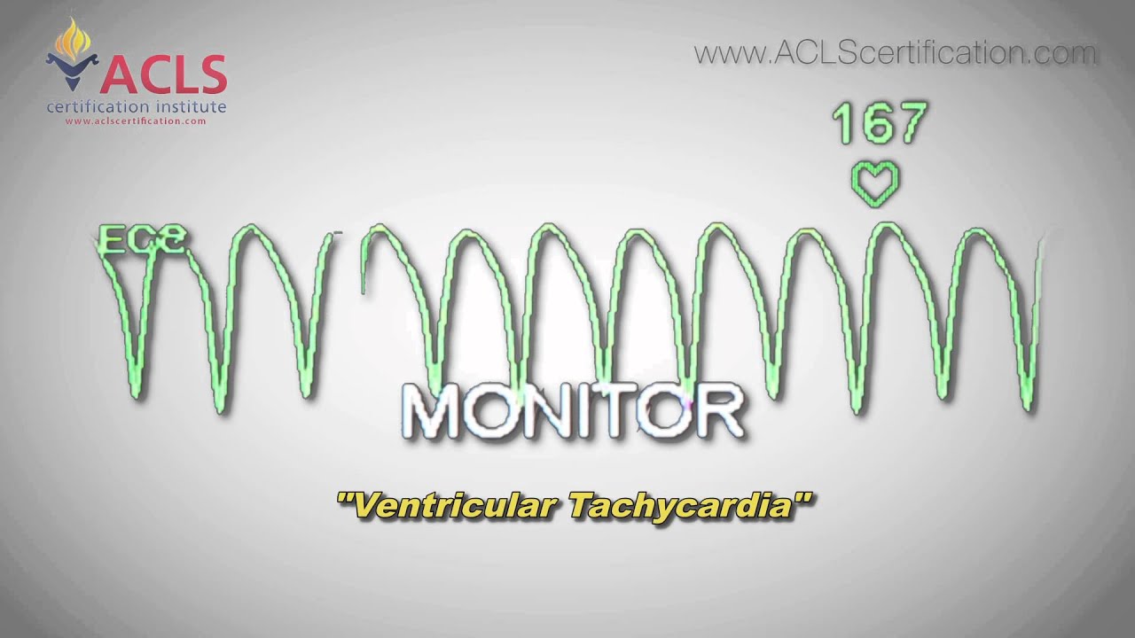 Ventricular Tachycardia by ACLS Certification Institute - YouTube