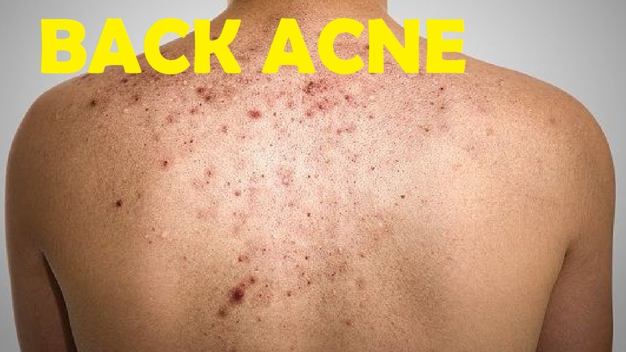 how to get rid of back acne naturally at home - YouTube