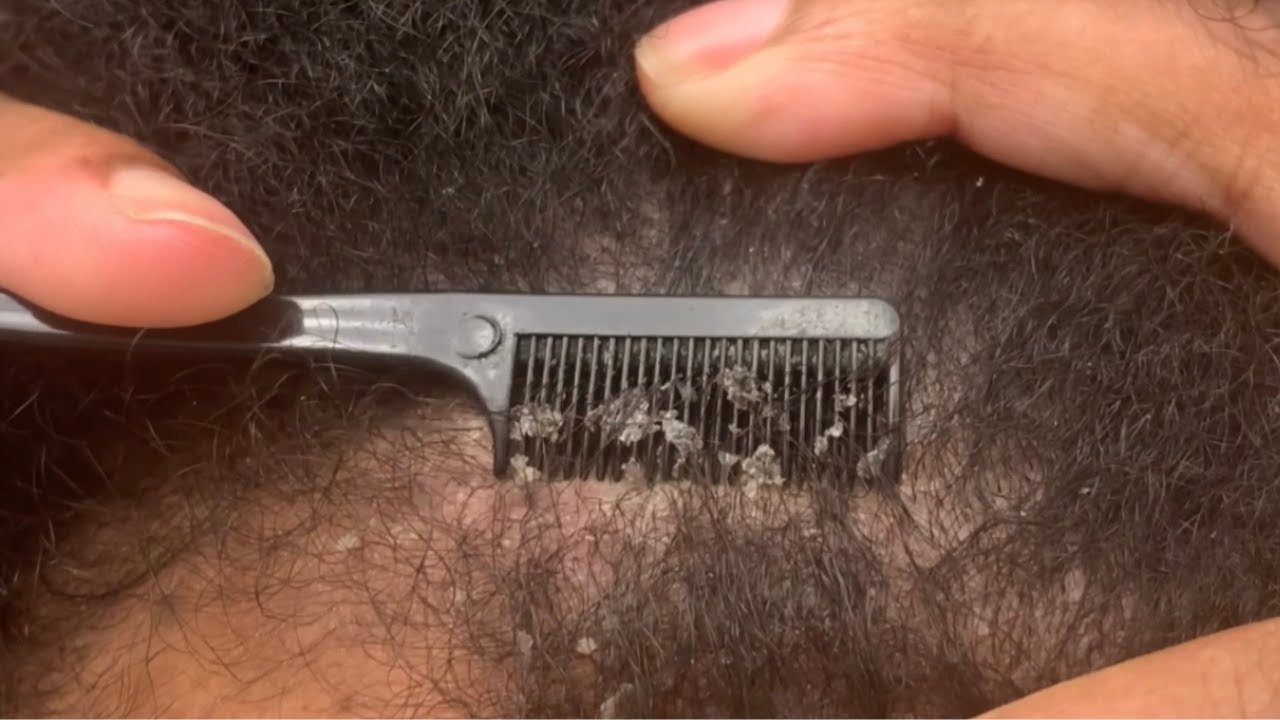 Wash Day Flakes | Flaky Eczema Scalp Picking ASMR - YouTube