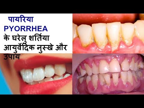 पायरिया के १० घरेलु आयुर्वेदिक नुस्खे और शर्तिया उपचार - BLEEDING GUMS ...