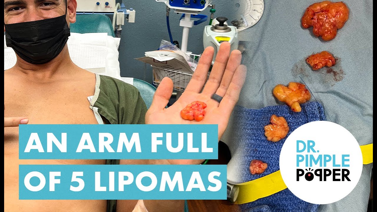 The Lipomas Just Don't Stop! Dr Pimple Popper Examines Patient's Arm ...