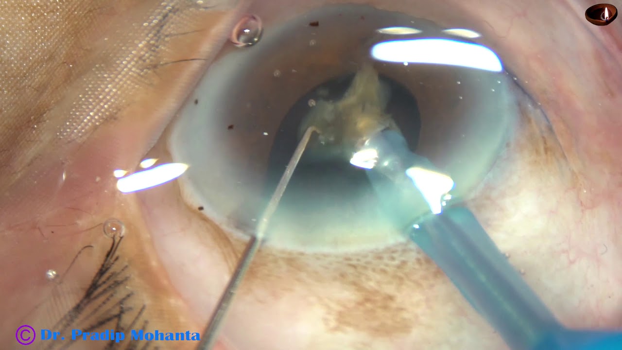 Intumescent Hard Cataract in a deep-seated eye with narrow Palpebral ...