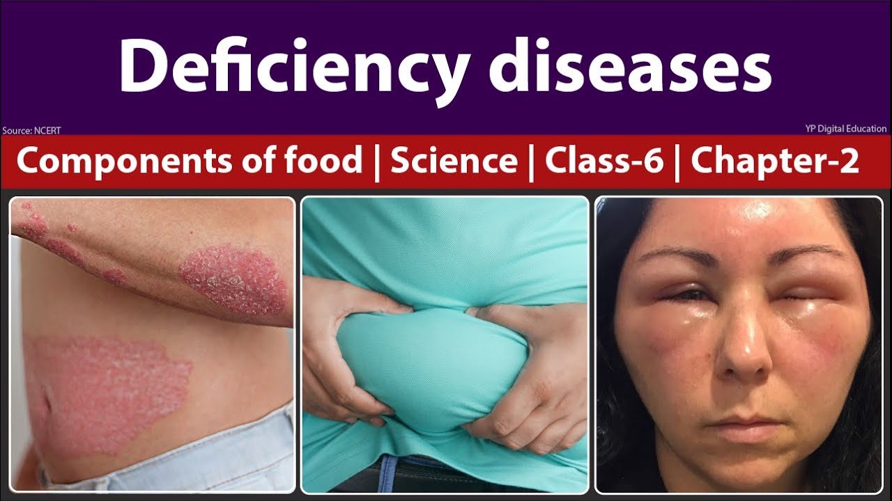 Components of food | Deficiency disease | NCERT Science | Class 6 ...