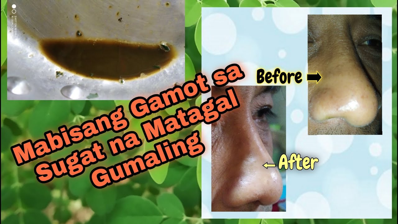 Mabisang Gamot sa Sugat na Matagal Gumaling | (Sugat sa Loob ng Ilong ...