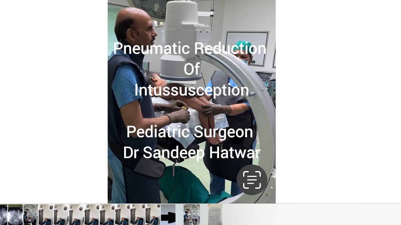 Pneumatic reduction of intussusception - YouTube