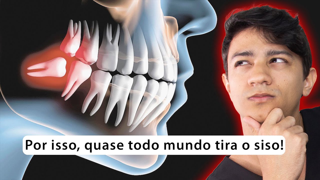 Por isso, quase todo mundo tira o siso! 🦷 - YouTube
