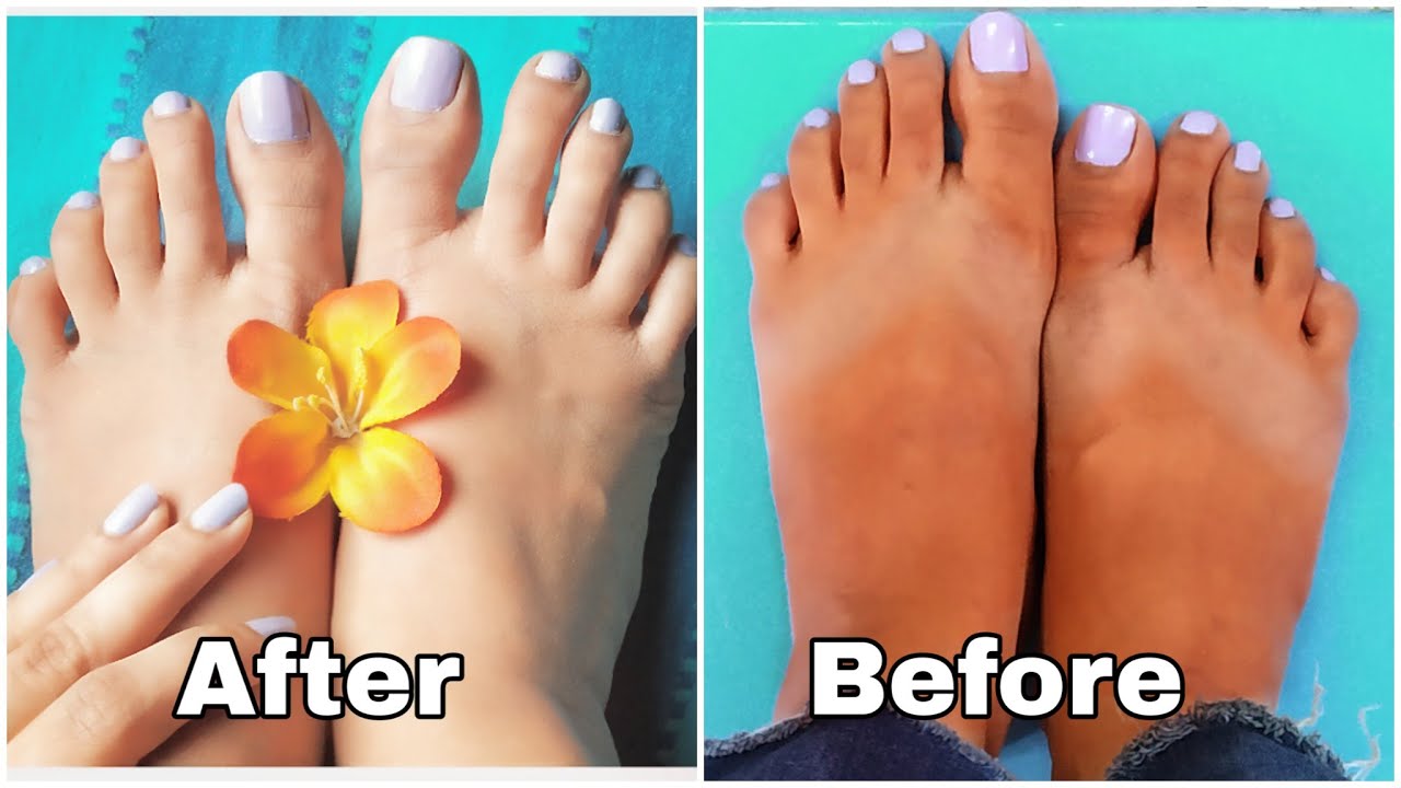 2 Step Feet Whitening Process ( हिंदी )- Remove Sun Tan & Dark Spots ...