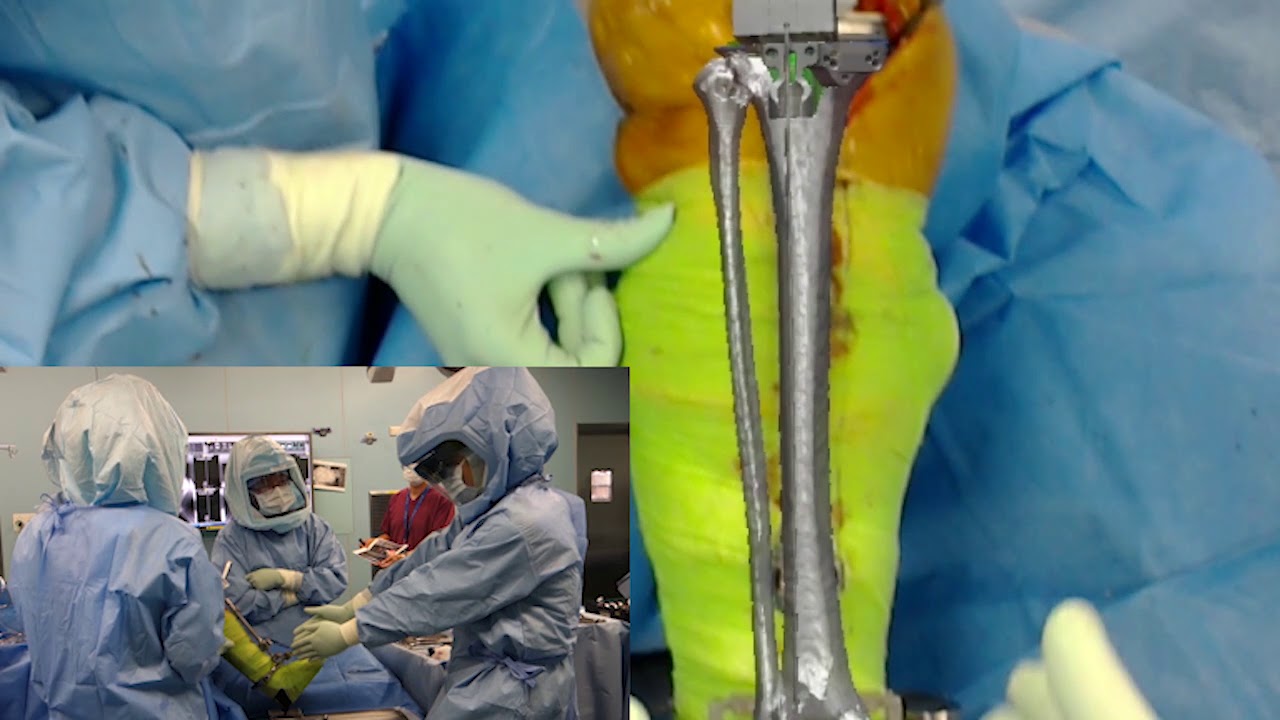 The HoloLens assisted surgery (Total Knee Arthroplasty:TKA) the world's ...