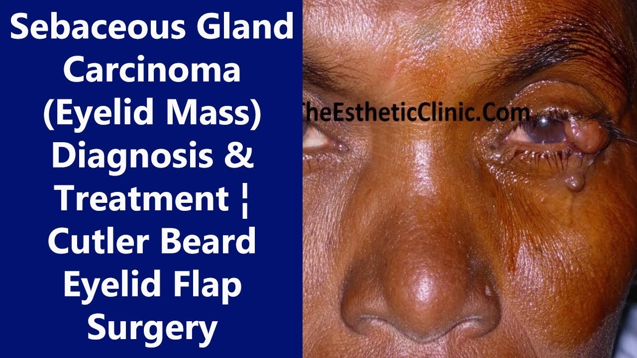 How Eyelid Mass Removed | Cutler Beard Eyelid Flap Surgery | The ...