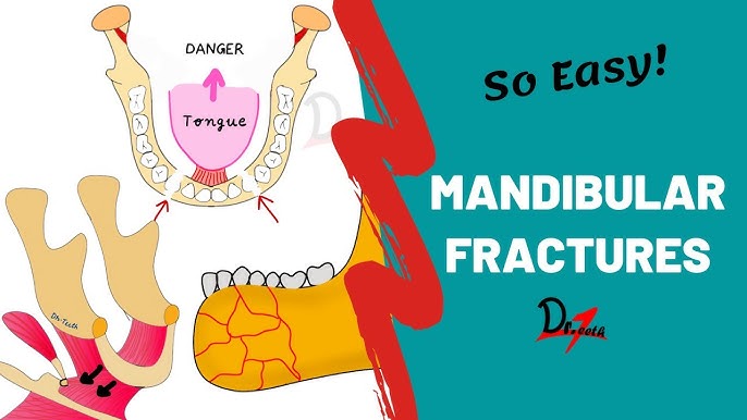 Mandible Fracture Classification