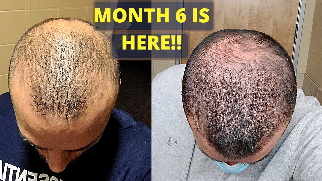 Month 6 ROGAINE RESULTS - MASSIVE SHED? - YouTube