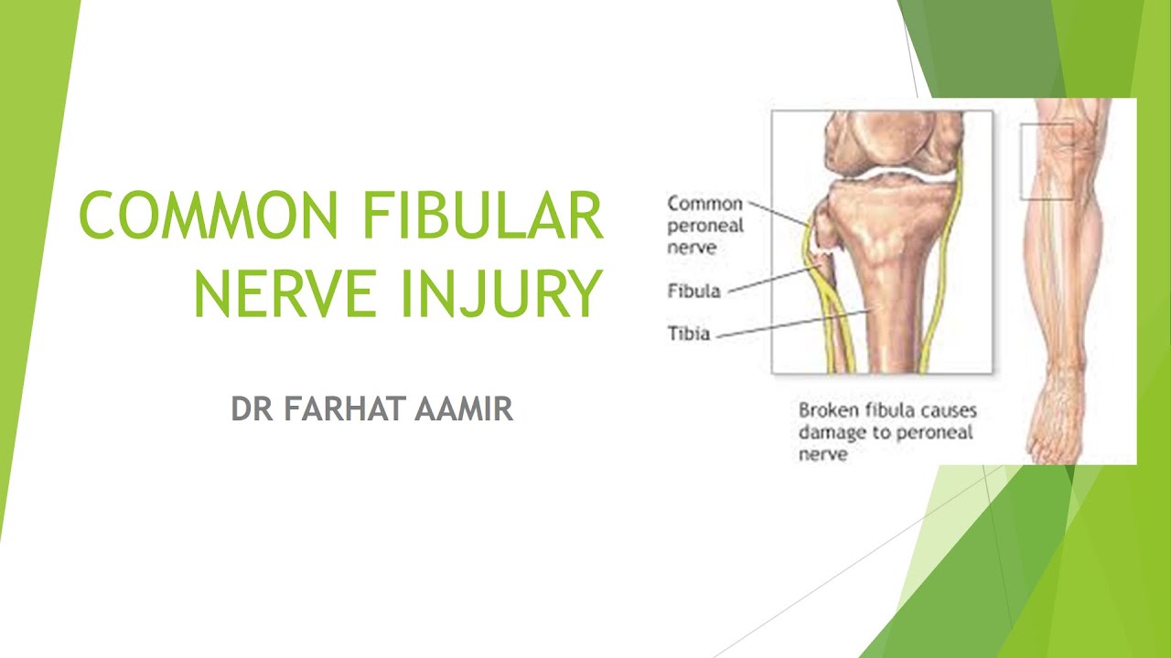 Common Fibular Nerve Injury - YouTube