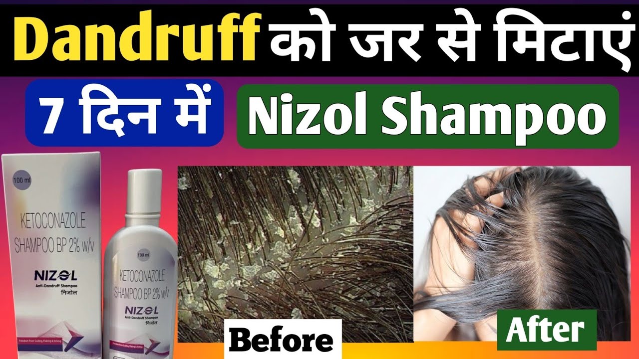 Nizol Shampoo Review || Anti Dandruff Shampoo || Ketoconazole Shampoo ...